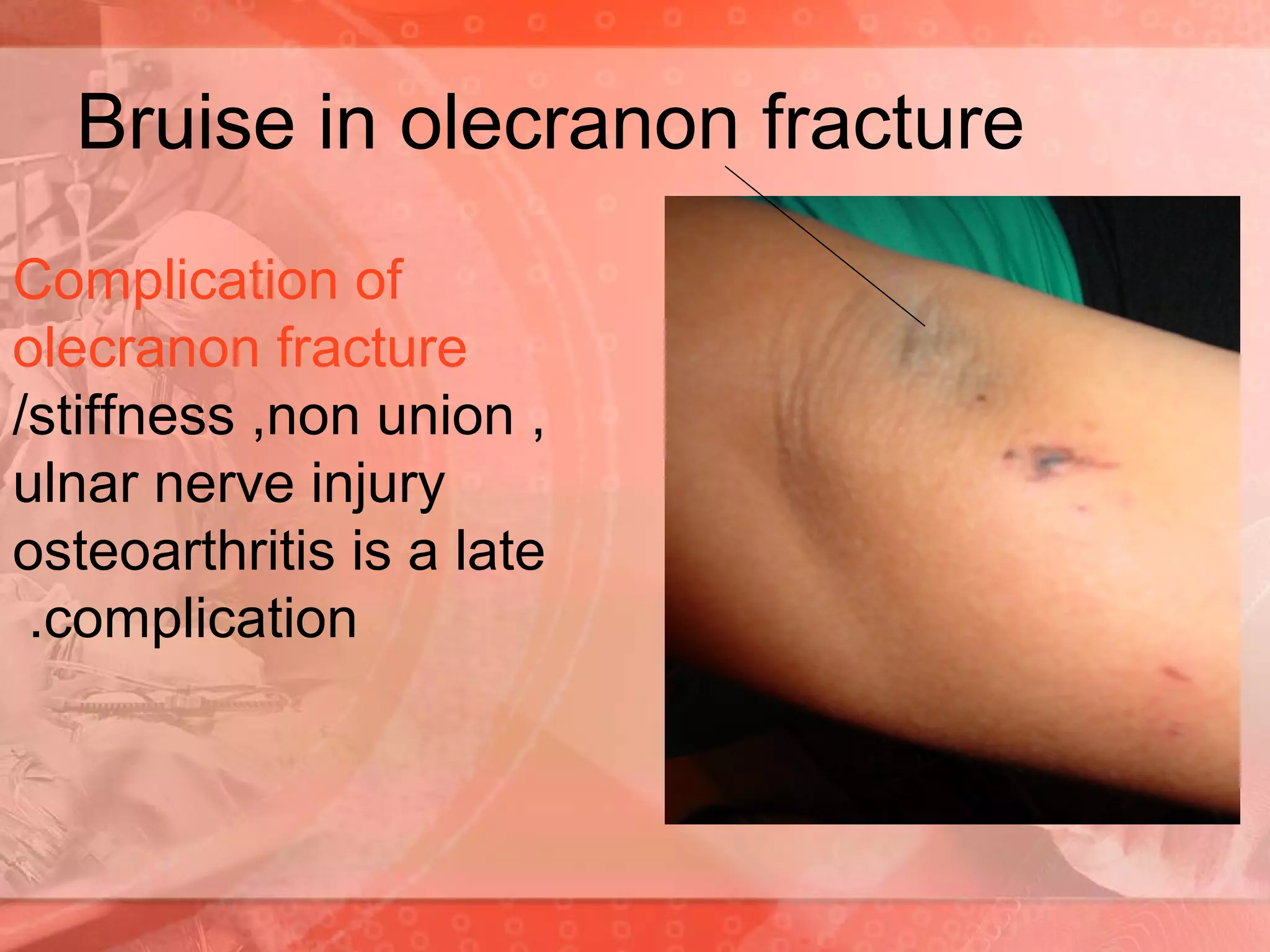 The elbow fracture | PPT