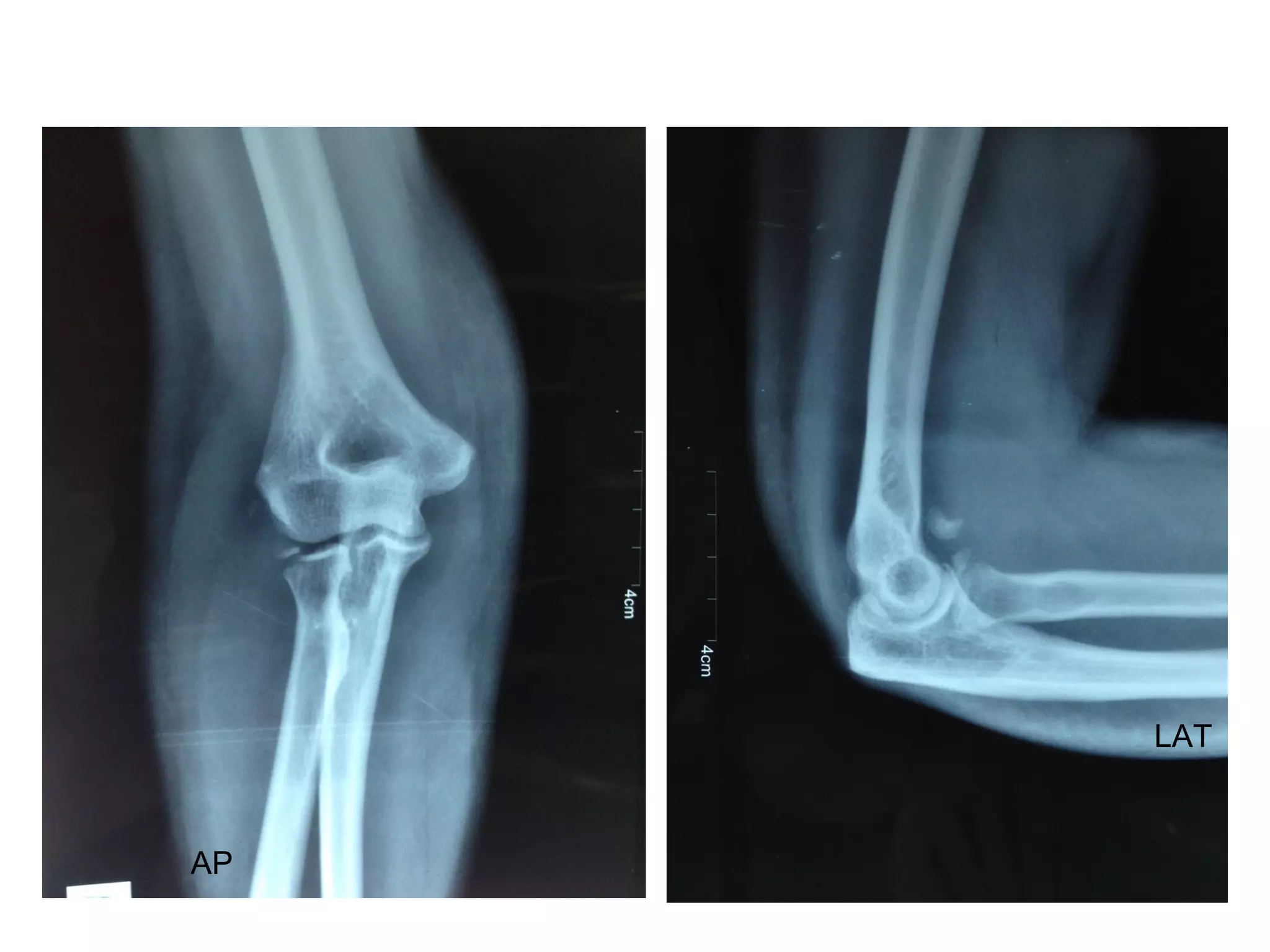 Radiology of the Elbow Joint. Dr. Sumit Sharma | PPT