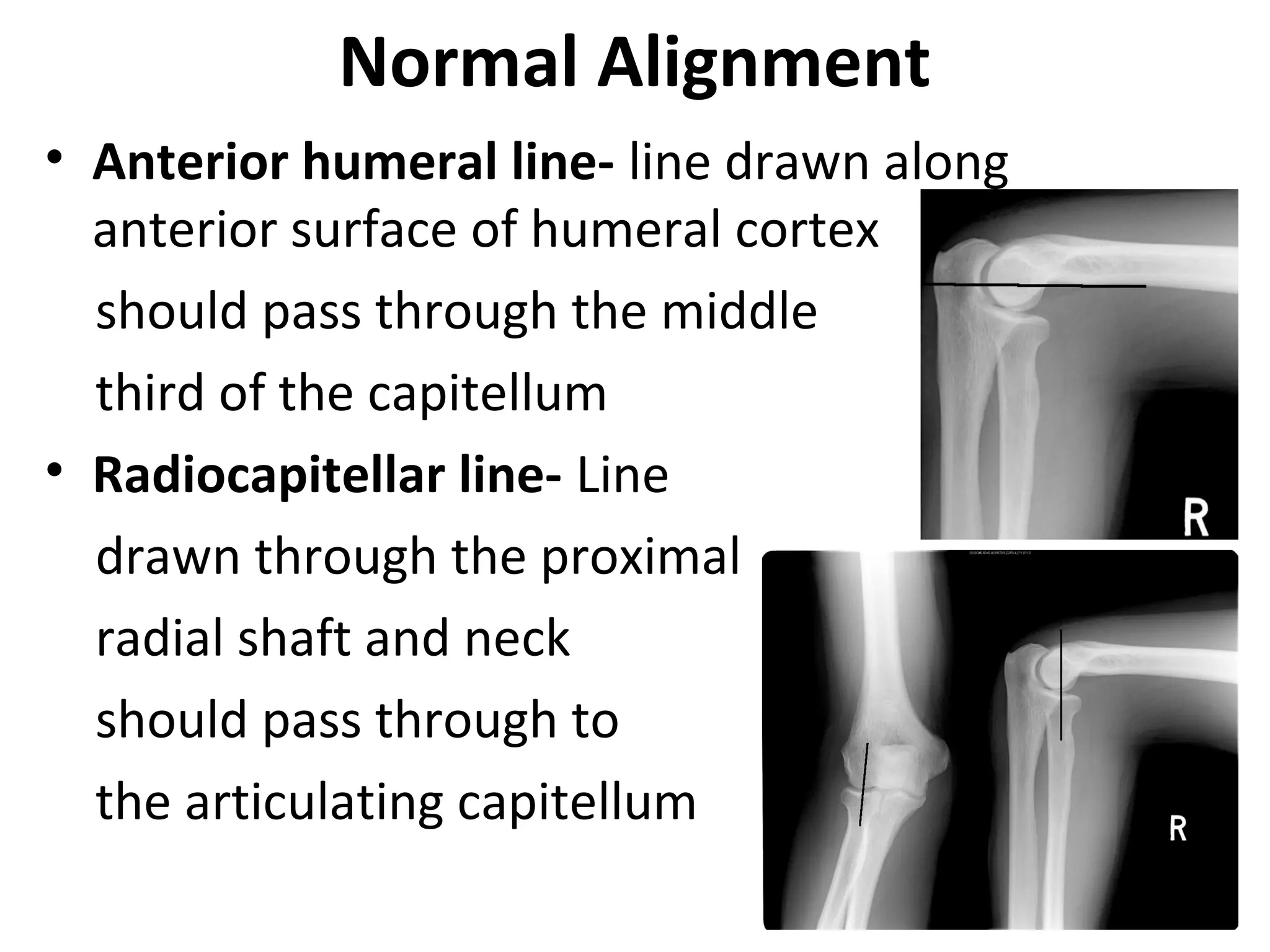 Radiology of the Elbow Joint. Dr. Sumit Sharma | PPT
