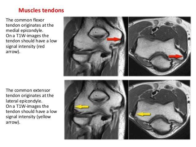 Common Flexor Tendon Elbow