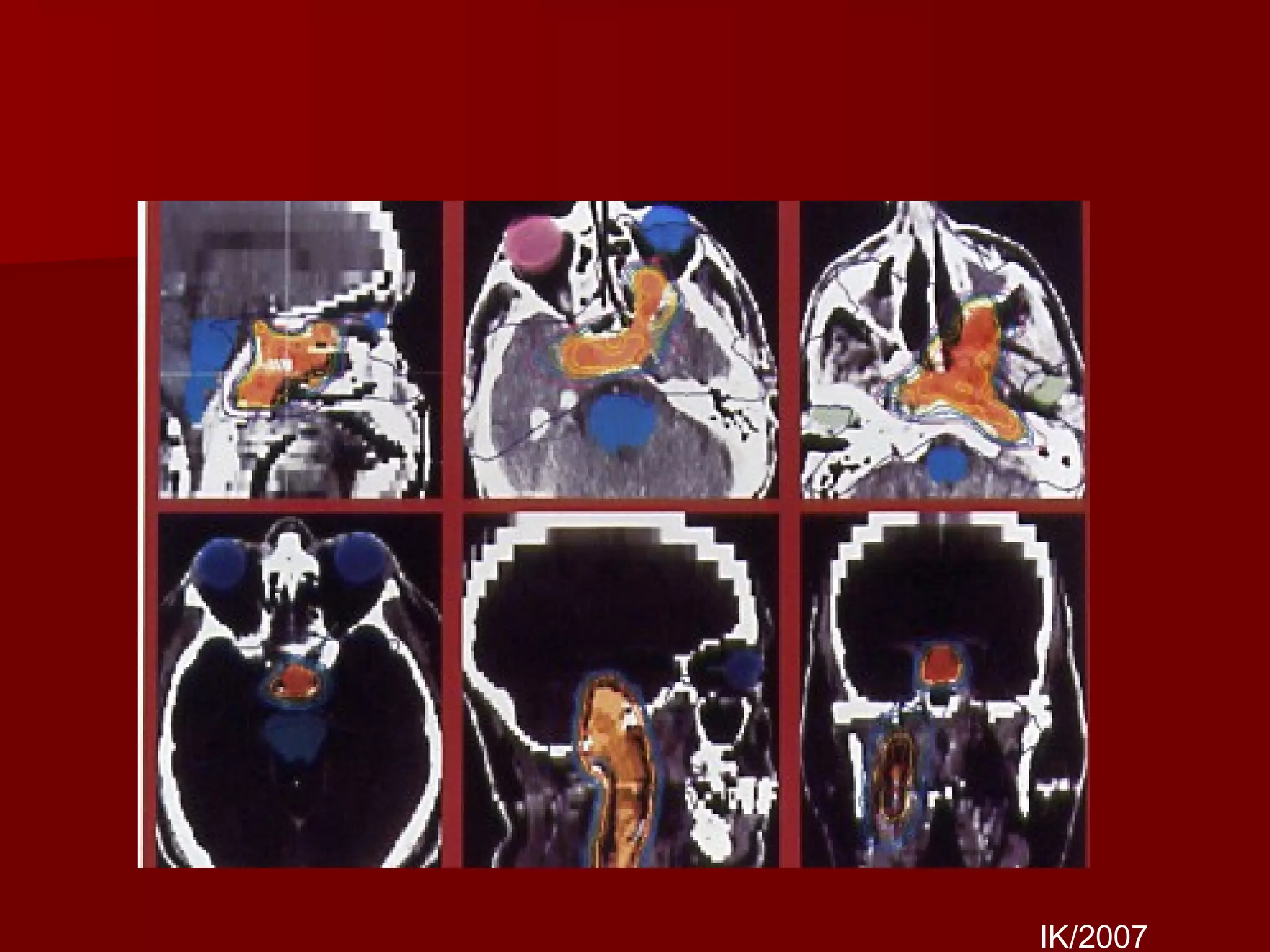 The evolution of radiotherapeutic techniques copy.ppt