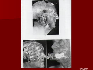 The evolution of radiotherapeutic techniques copy.ppt