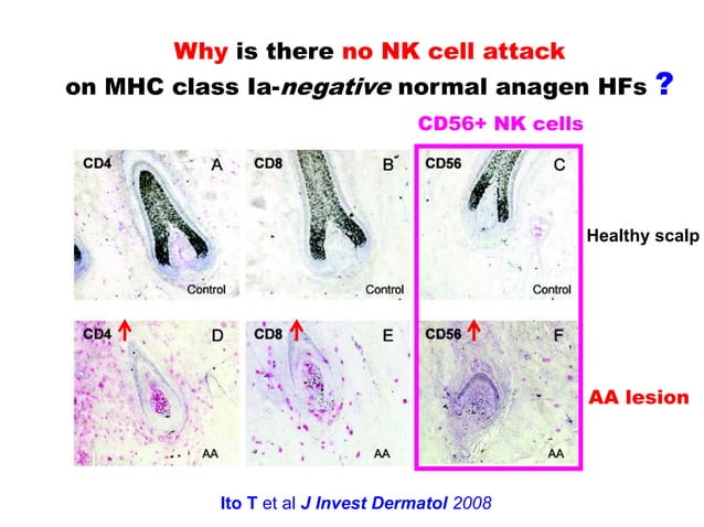 The evolving pathogenesis of alopecia areata and biomarkers of disease ...