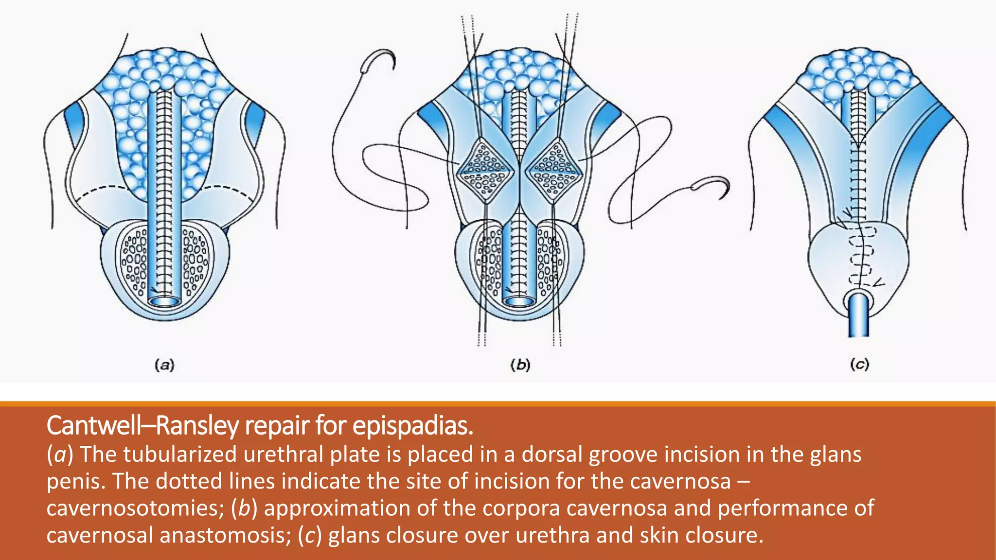 The exstrophy epispadias complex | PDF