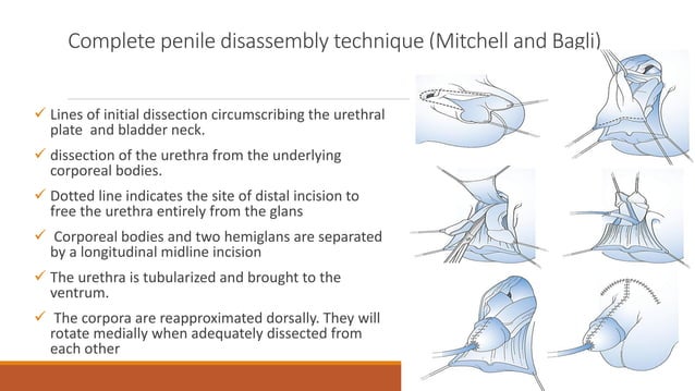 The exstrophy epispadias complex | PDF
