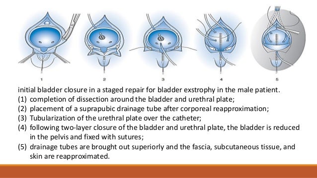 The exstrophy epispadias complex