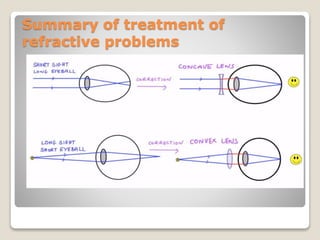 The Eye - Myopia, Hyperopia, Lenses and Laser Eye Surgery | PPTX