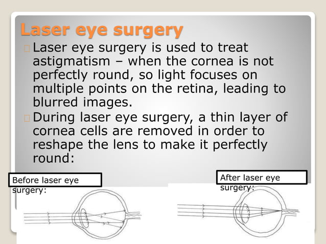 The Eye - Myopia, Hyperopia, Lenses and Laser Eye Surgery | PPT