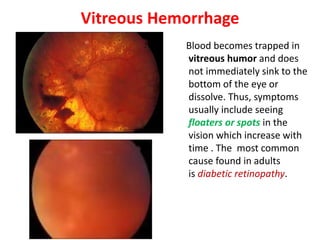 The eyeball anatomy | PDF
