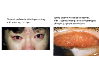 The eyeball anatomy | PDF