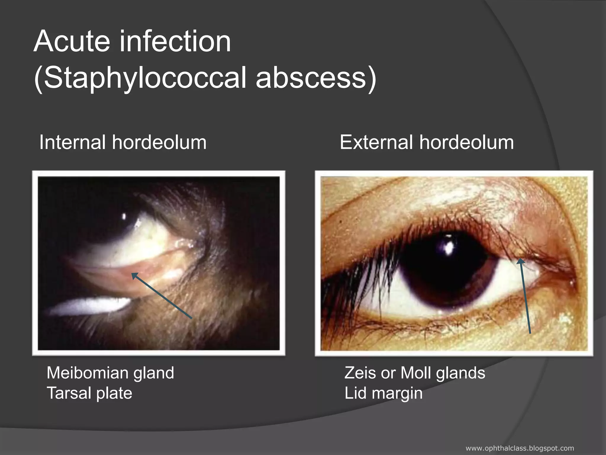 Lids and Adnexa Class1: The eyelid margin | PPTX
