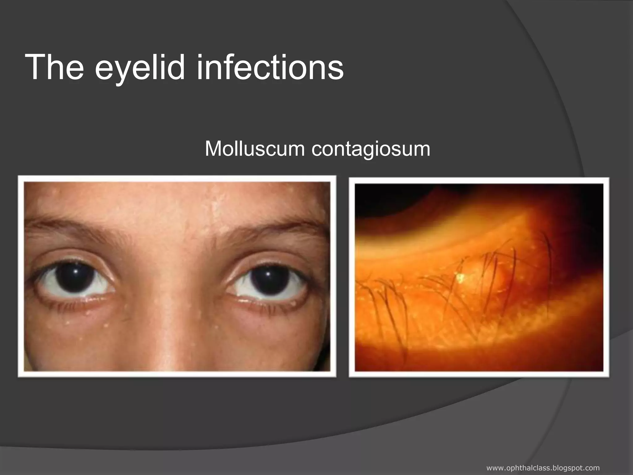 Lids and Adnexa Class1: The eyelid margin | PPTX