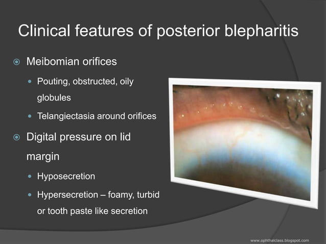 Lids and Adnexa Class1: The eyelid margin | PPTX