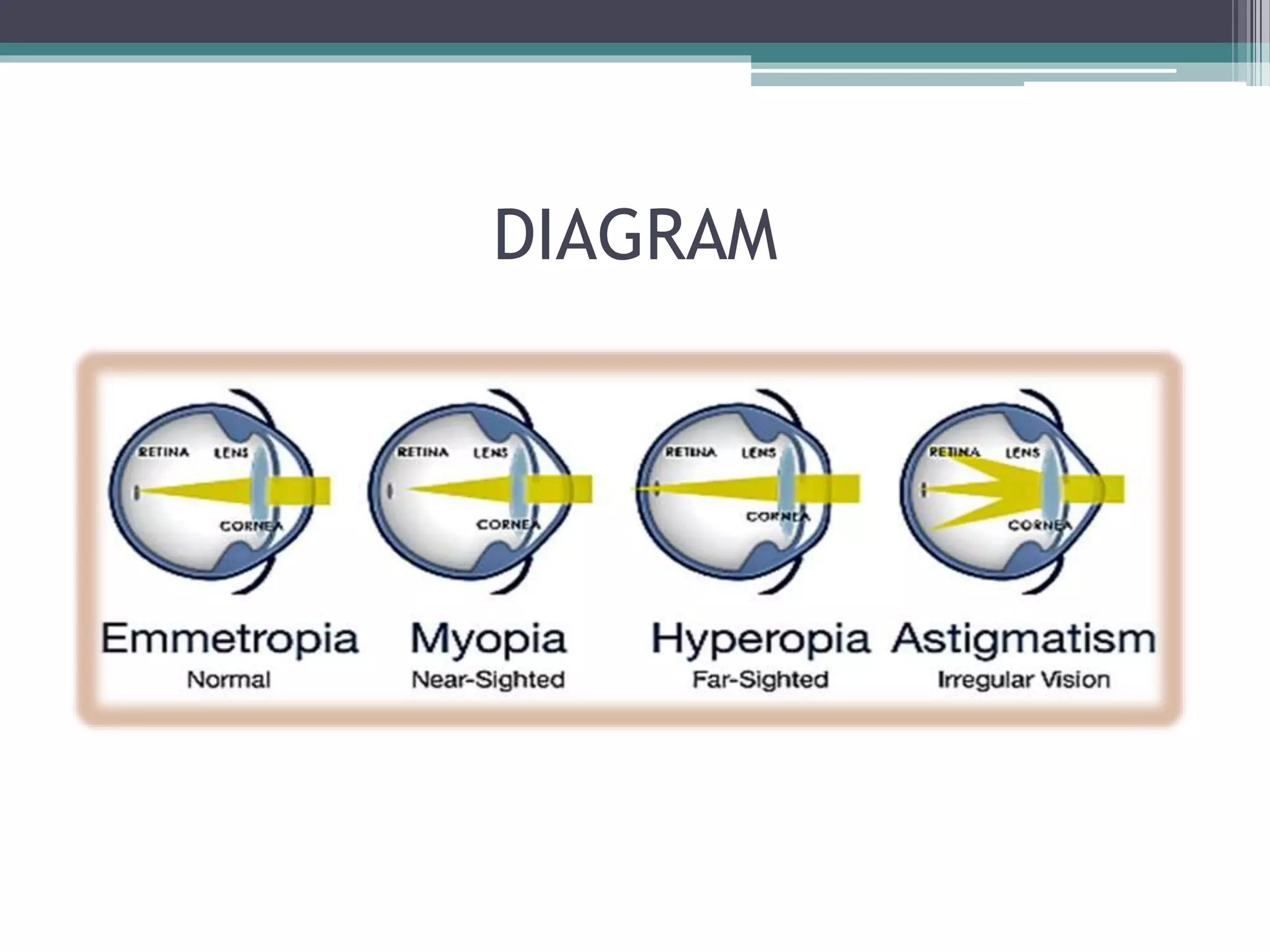 The Optics of Human Eye & Gallstrand schematic eye | PPTX