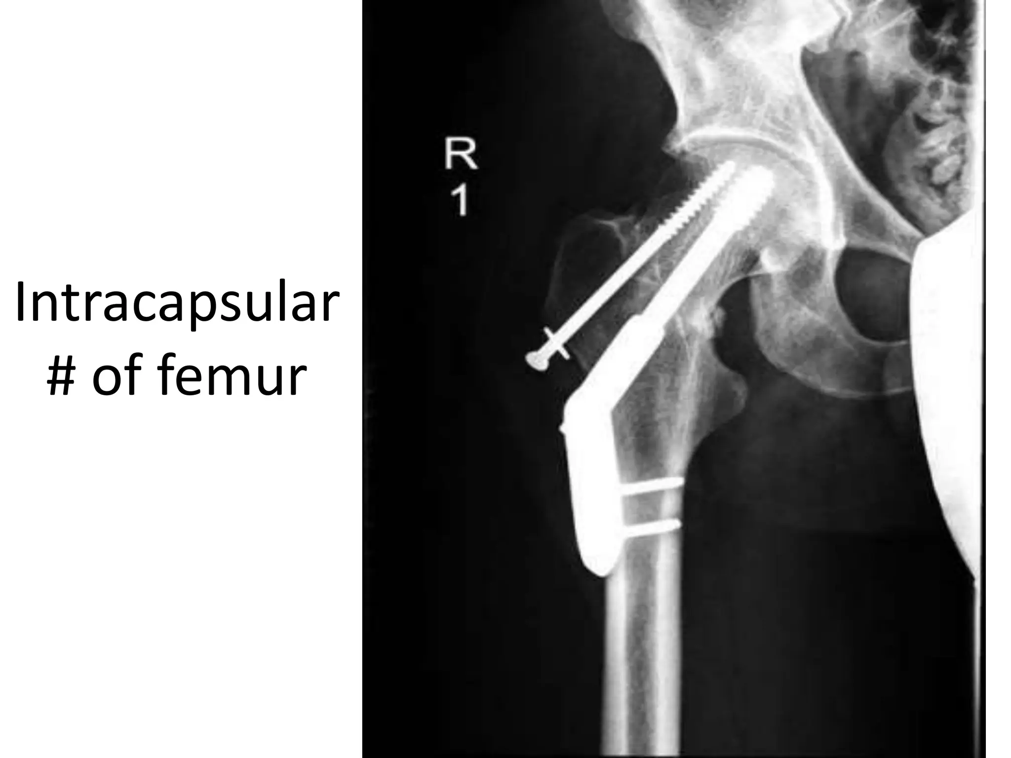 The anatomy of Femur features and attachments.pptx
