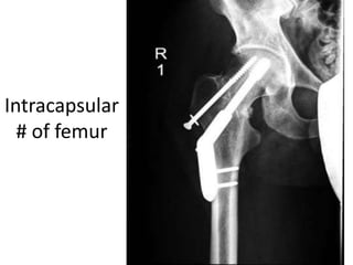 The anatomy of Femur features and attachments.pptx