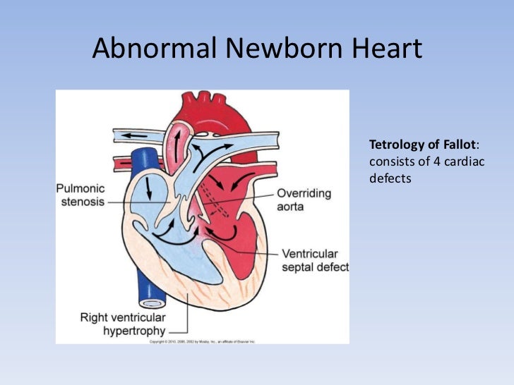 The fetal and newborn heart ppp