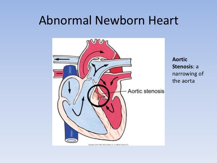 The Fetal And Newborn Heart Ppp