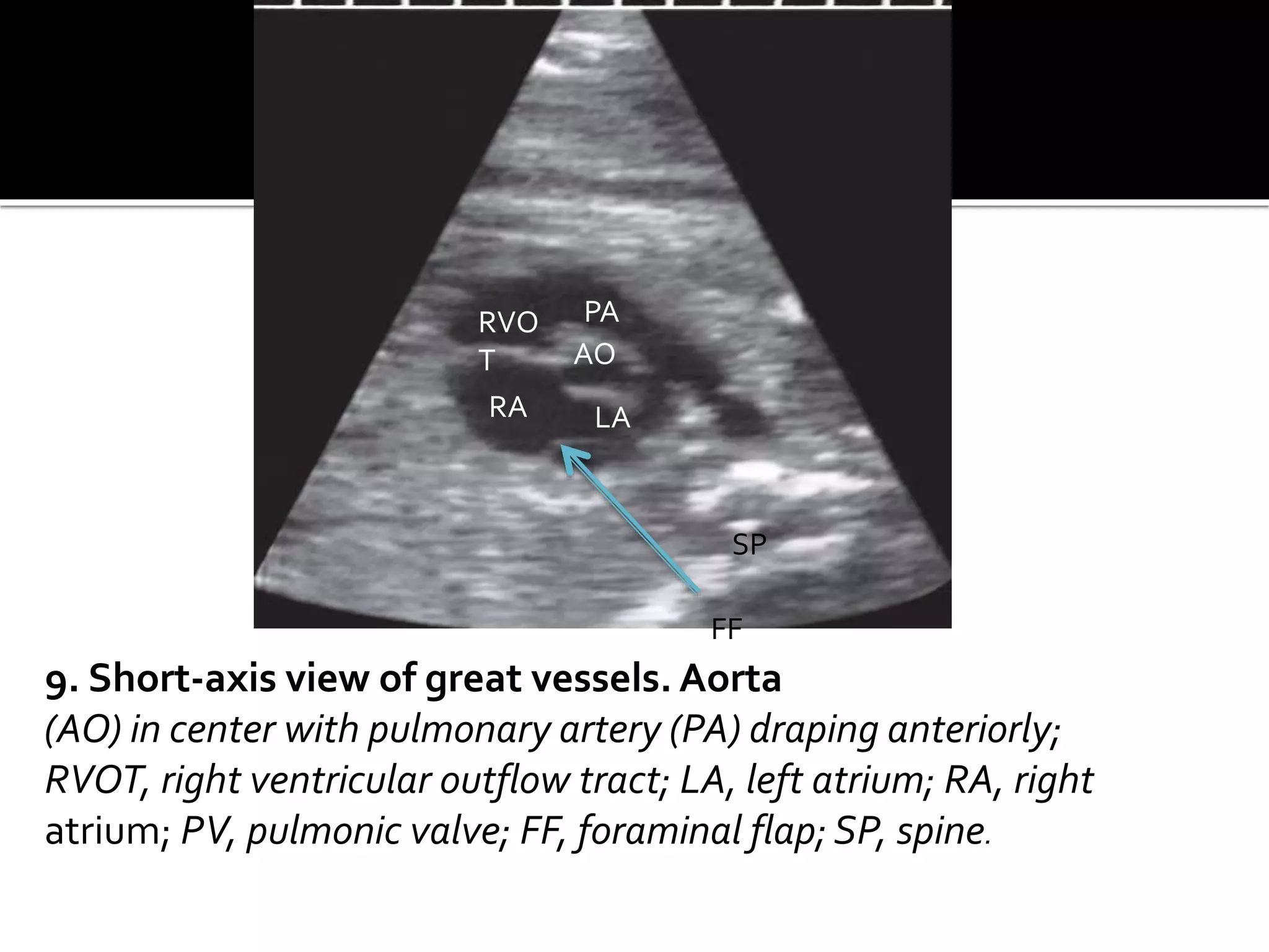The fetal heart | PPTX