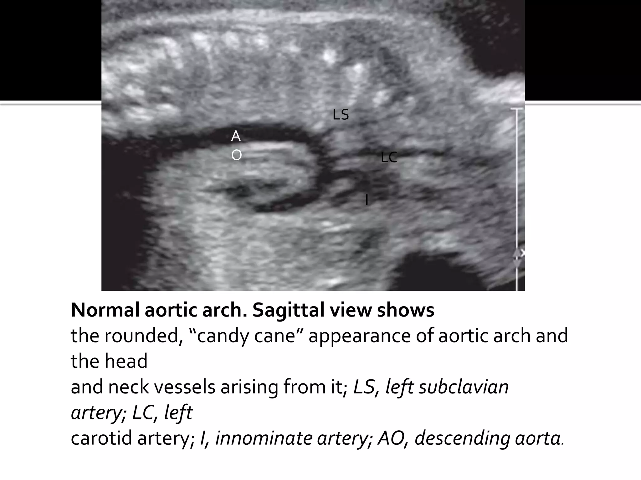 The fetal heart | PPTX