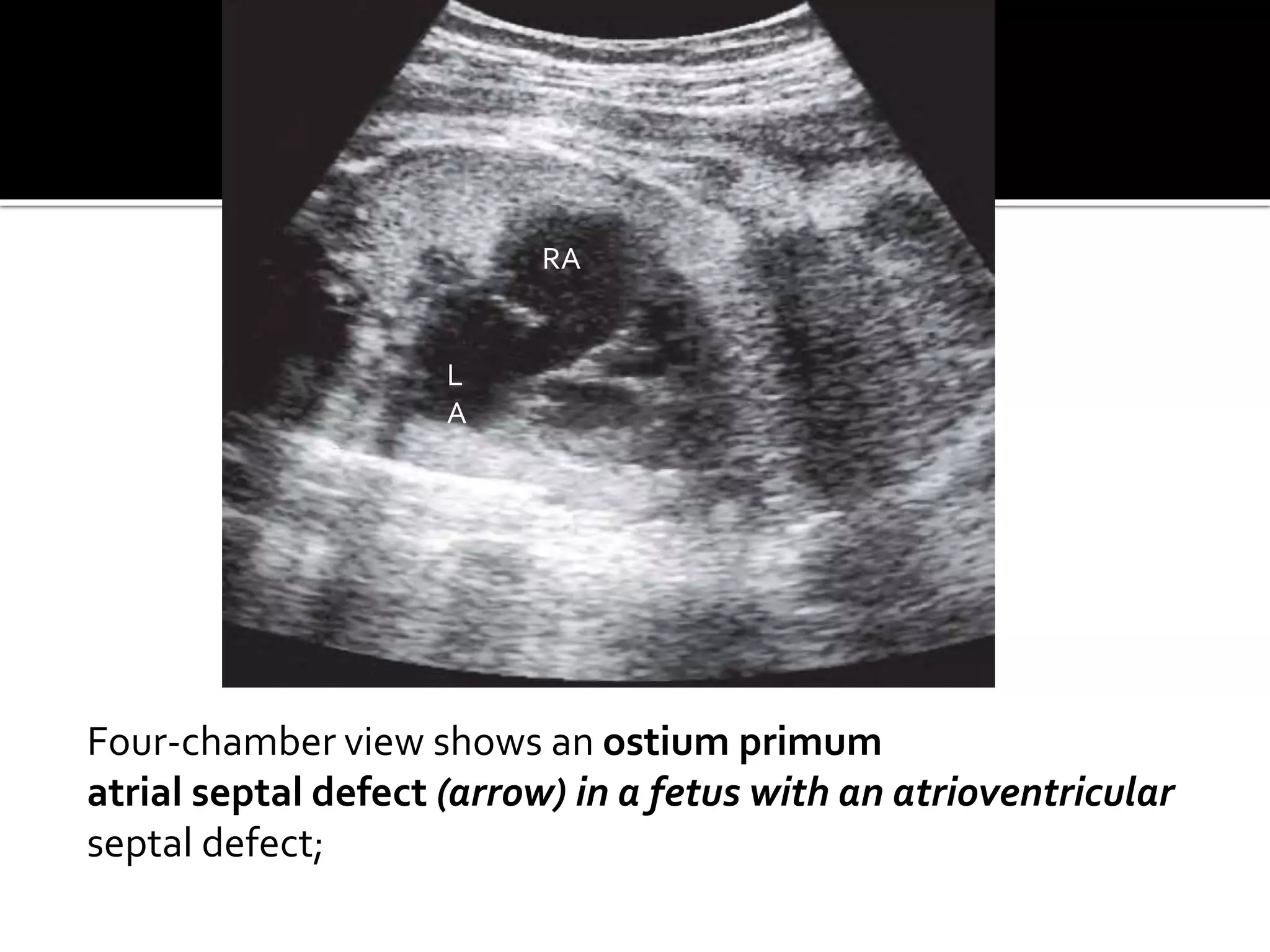 The fetal heart | PPTX