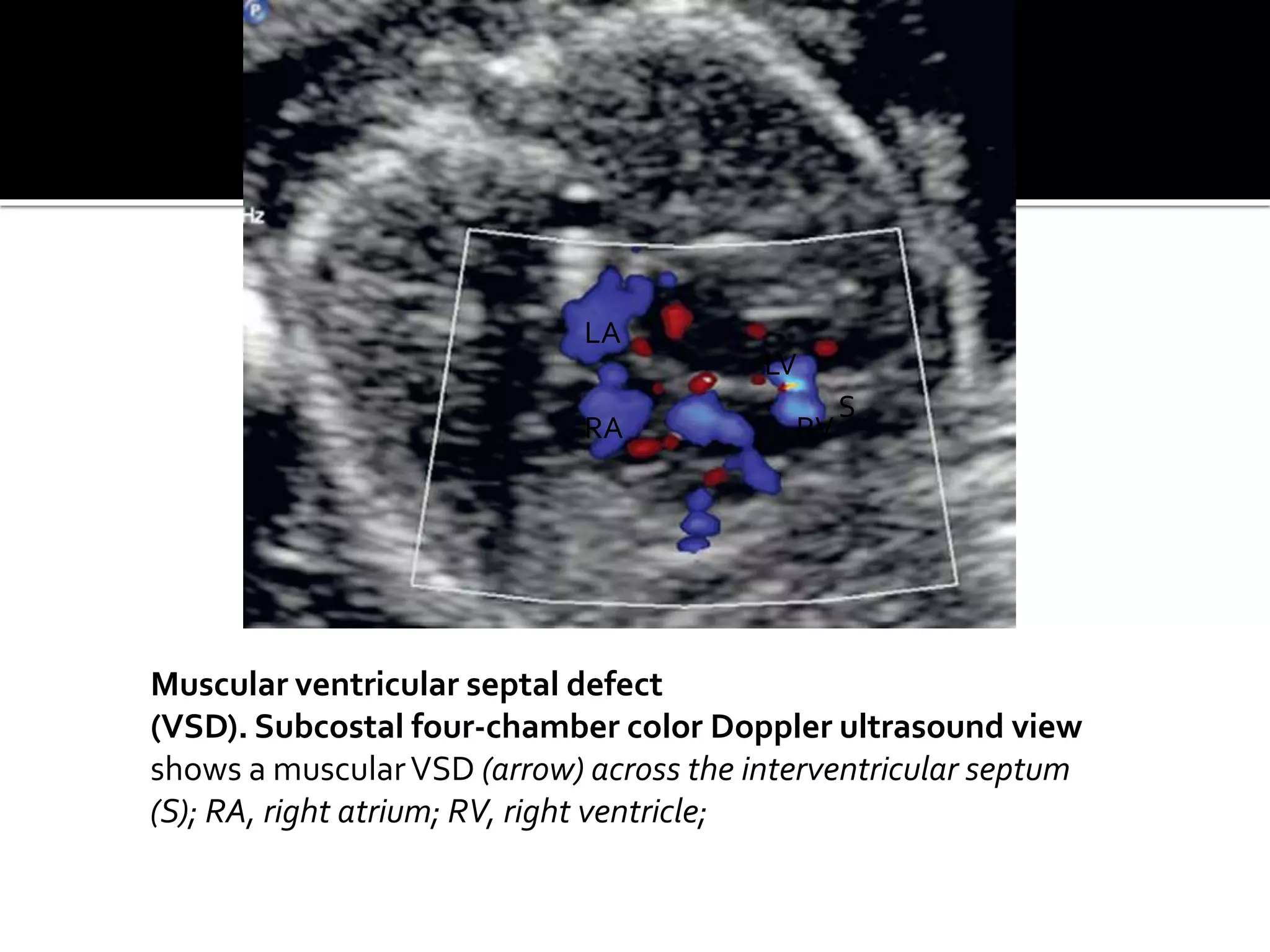 The fetal heart | PPTX