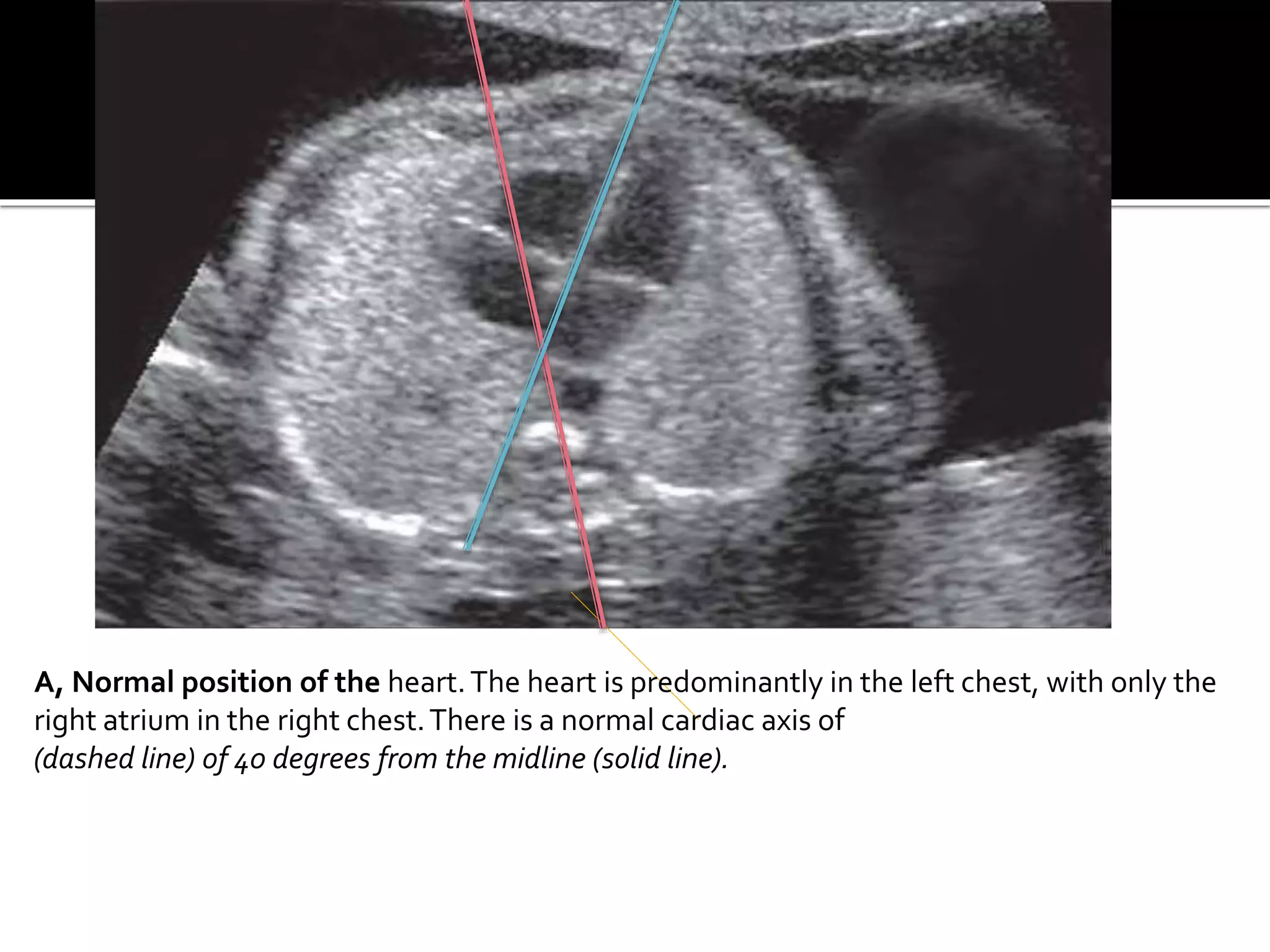The fetal heart | PPTX
