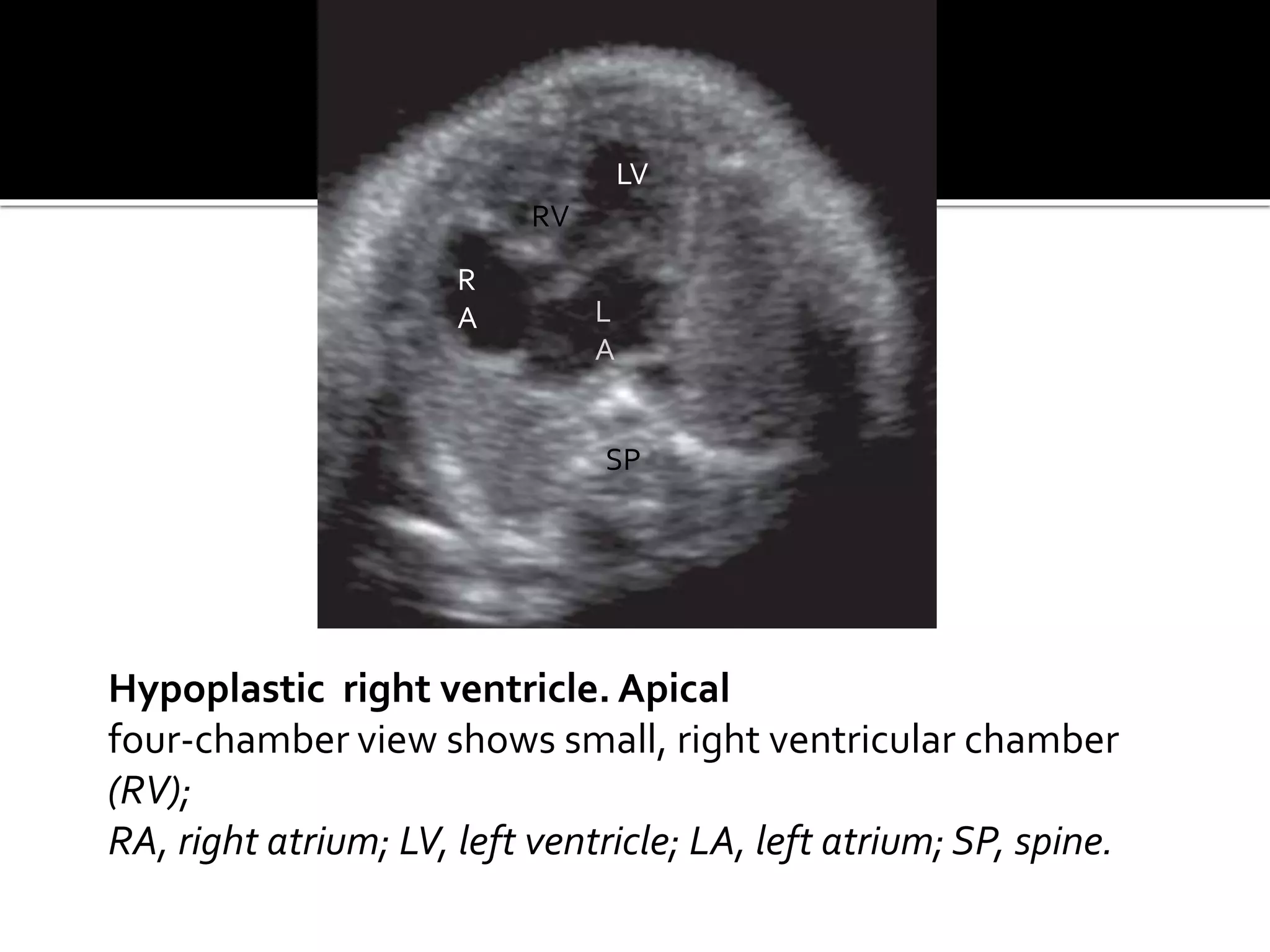 The fetal heart | PPTX
