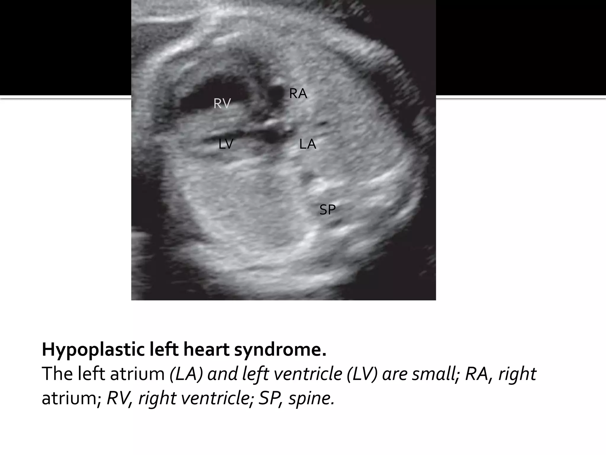 The fetal heart | PPTX