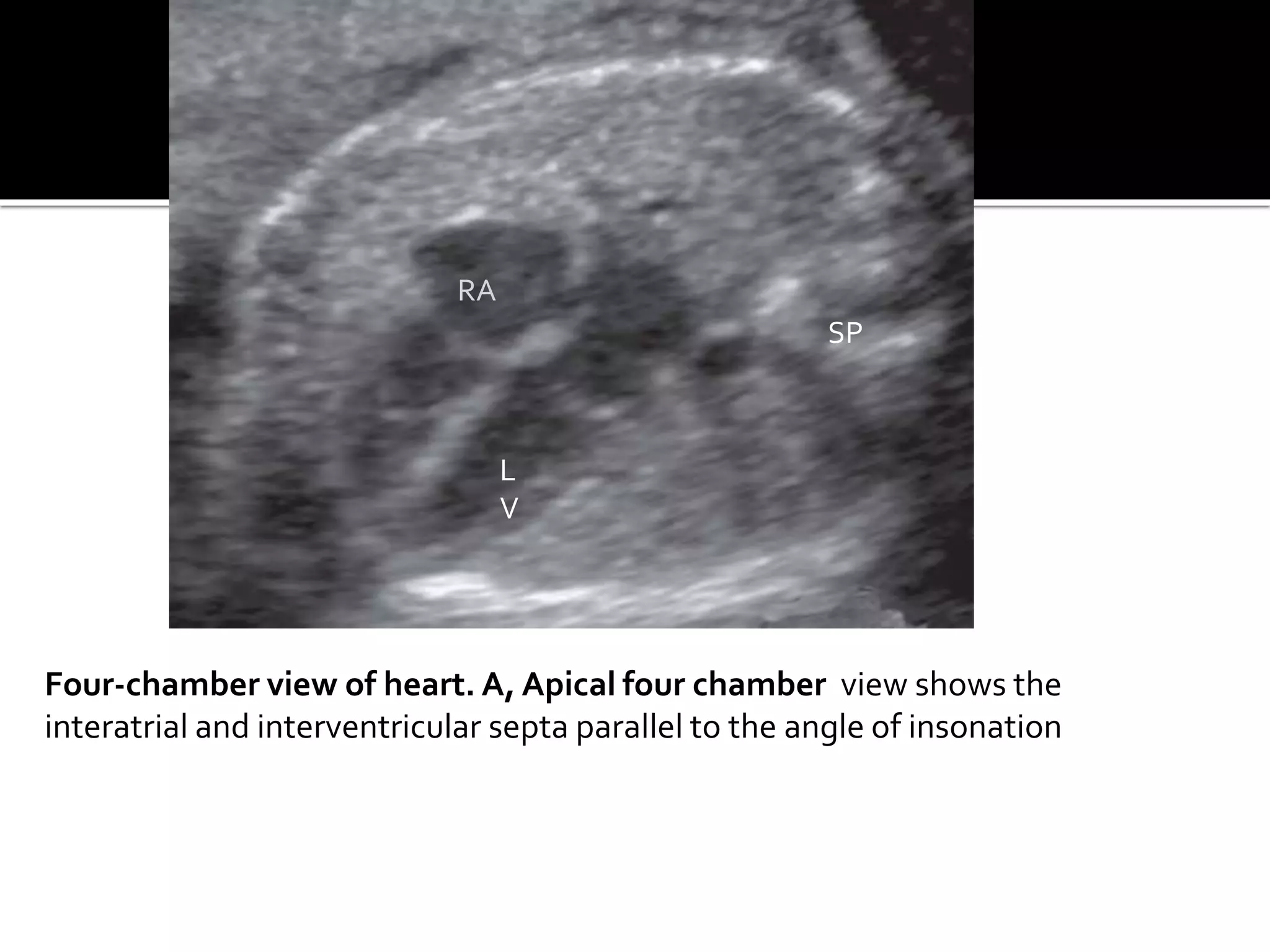 The fetal heart | PPTX