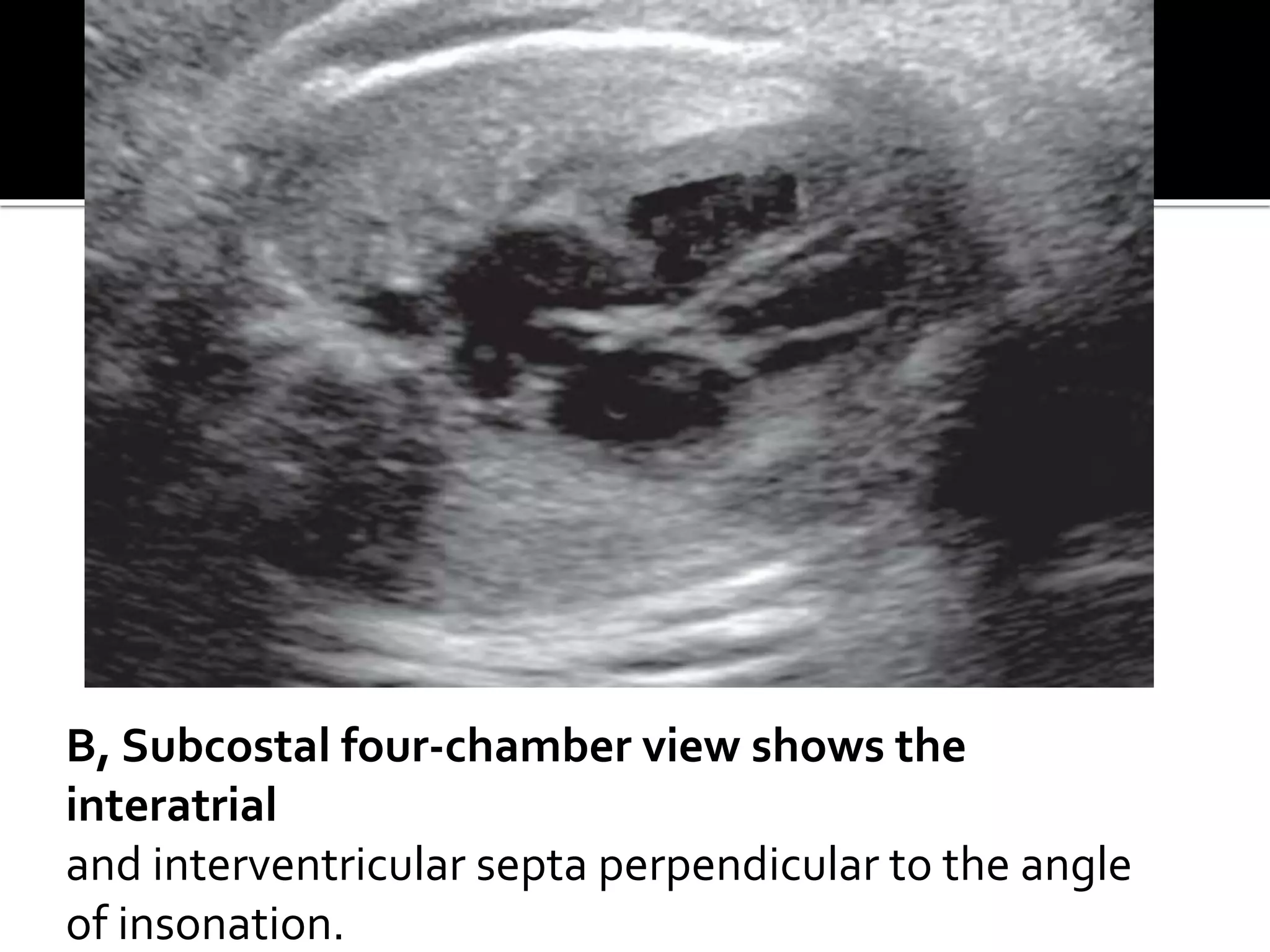 The fetal heart | PPTX