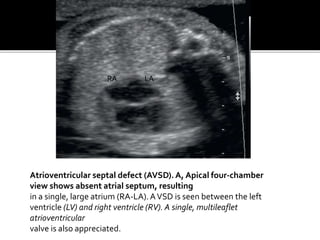 Atrioventricular Septal Defect Ultrasound