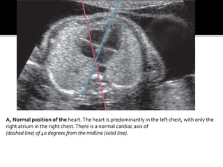 Fetal Heart