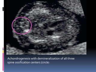Ultrafhuaime Achondrogenesis