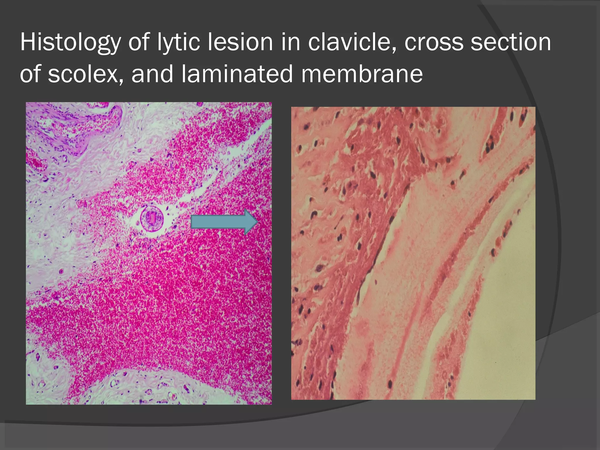 Cytopathology of lesions in bone | PPT | Bone and Joint Conditions ...
