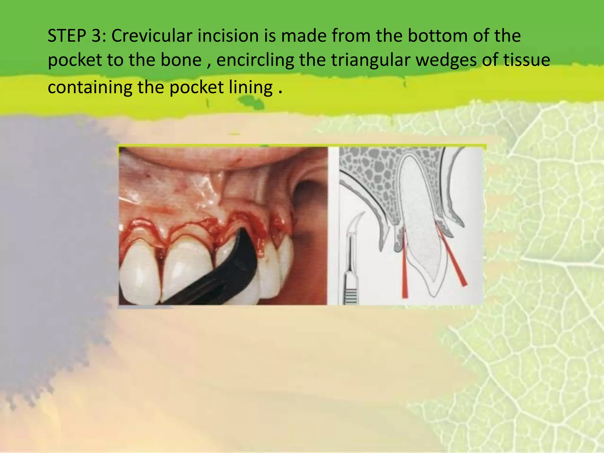 The flap technique | PPTX