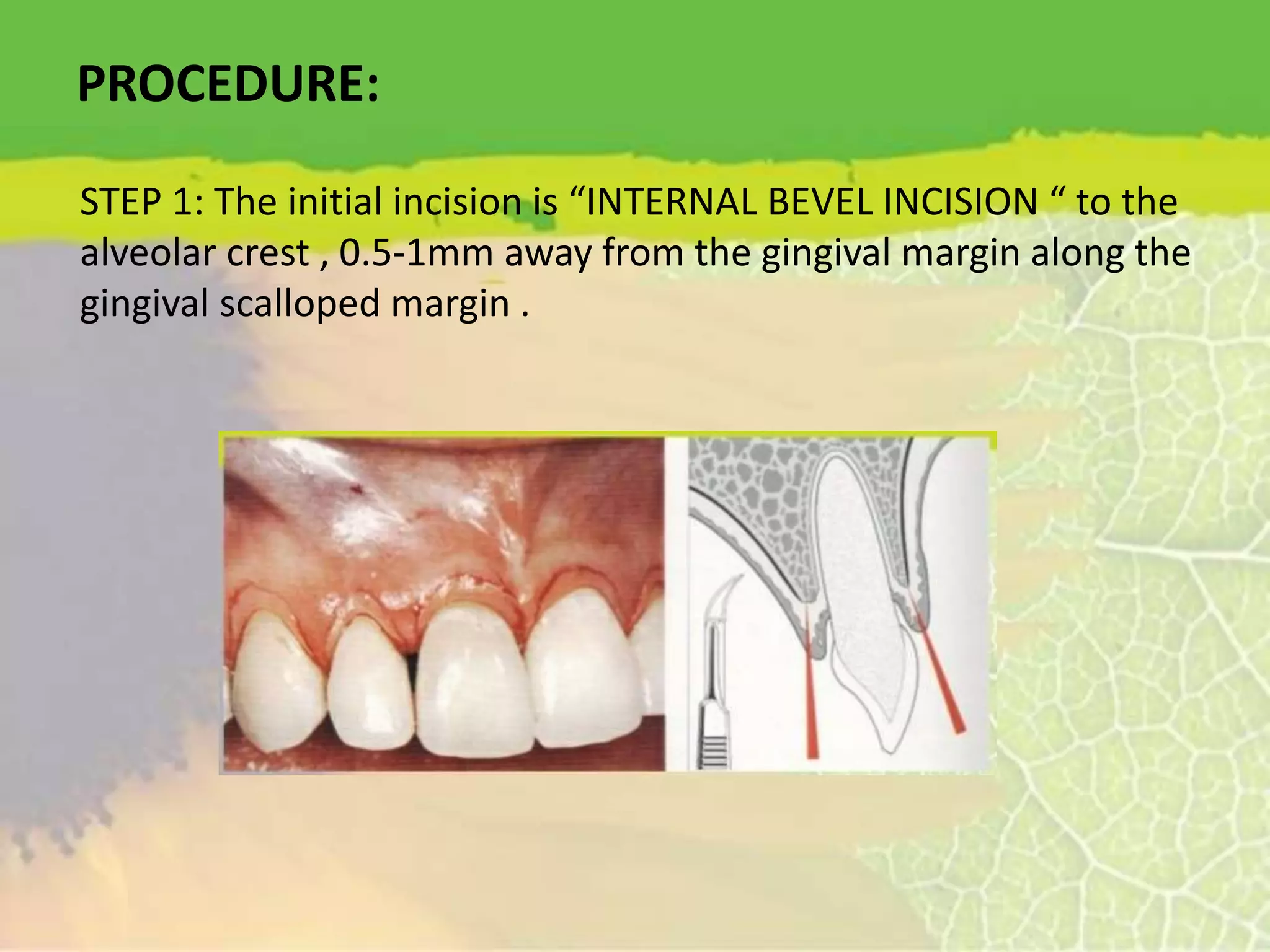 The flap technique | PPTX