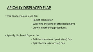 The flap technique for pocket therapy | PPTX