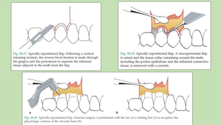 The flap technique for pocket therapy | PPTX
