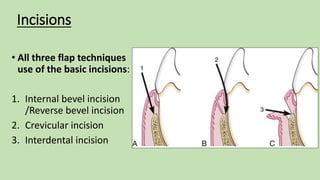 The flap technique for pocket therapy | PPTX