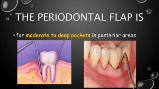 The flap techniques for pocket therapy | PPTX