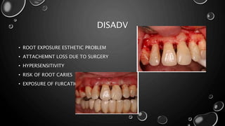 The flap techniques for pocket therapy | PPTX
