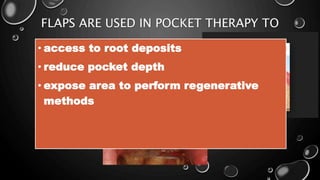The flap techniques for pocket therapy | PPTX