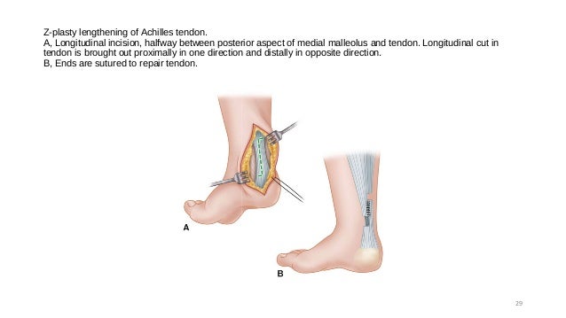 The foot in cp part 1 of 3