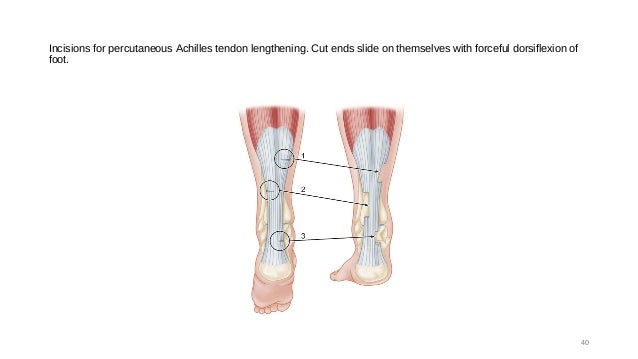 The foot in cp part 1 of 3