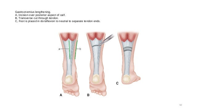 The foot in cp part 1 of 3