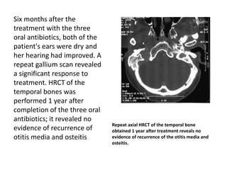 The formation and management of middle ear granulation | PPT