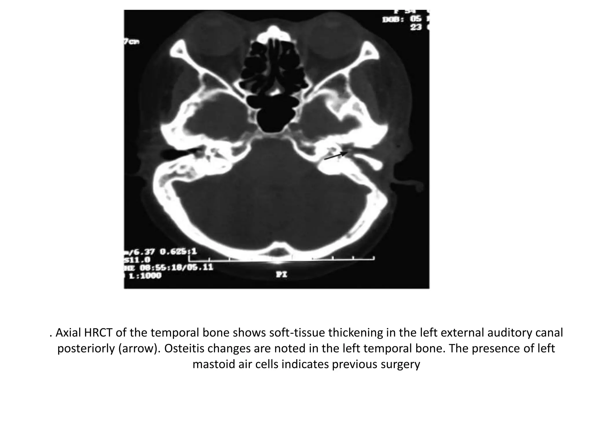 The formation and management of middle ear granulation | PPTX