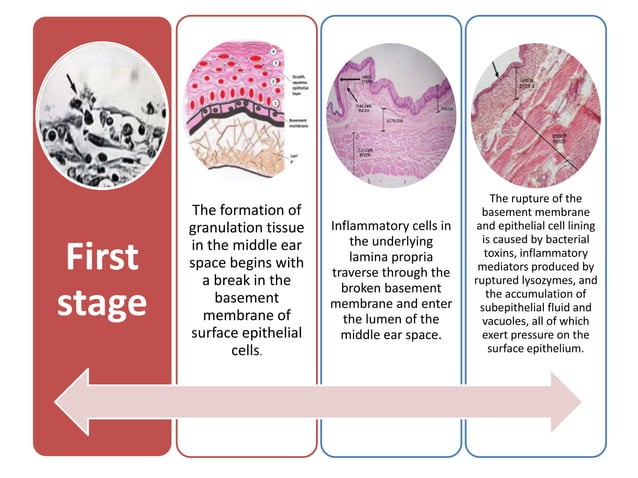 The formation and management of middle ear granulation | PPTX | Ear ...