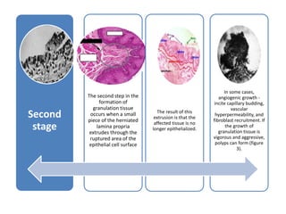 The formation and management of middle ear granulation | PPTX